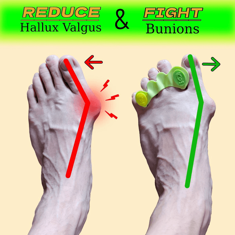 Toe Spreaders by Allways barefoot - Combat Bunions & Strengthen Arches ...